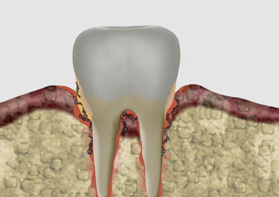 About Gum Disease Midtown Manhattan Dr Philip Pack